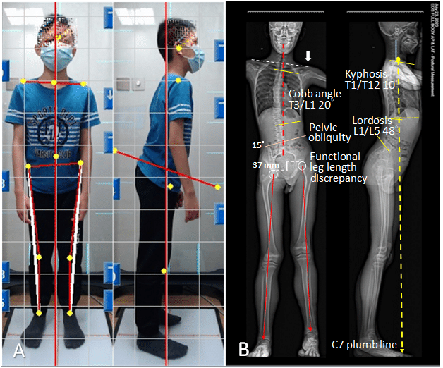 فحص استقامة الجسم باتخدام التصوير الفوتوغرافي